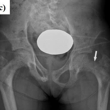 A Plain Radiographs Show Diffuse Osteopenia Thoracolumbar Download Scientific Diagram