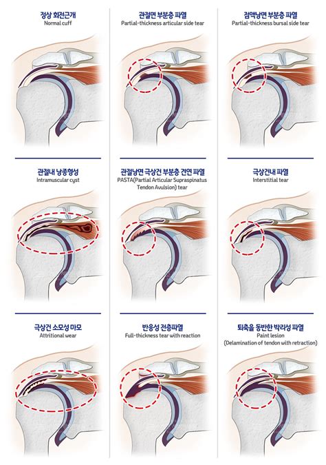 회전근개파열 치료법 수술이 정답일까