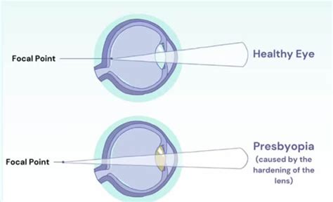 Refractive Errors Types Signs Causes And Treatment