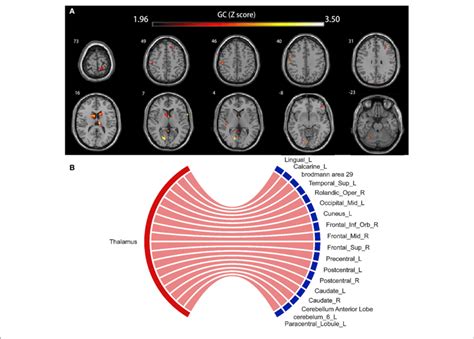 Voxel Based Causal Network Of Structural Covariance Cascn Thalamus Download Scientific