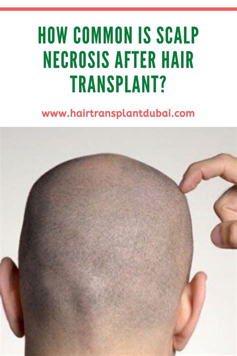 Top 181 Scalp Necrosis After Hair Transplant Polarrunningexpeditions