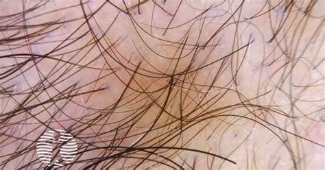 Male Pattern Hair Loss Image
