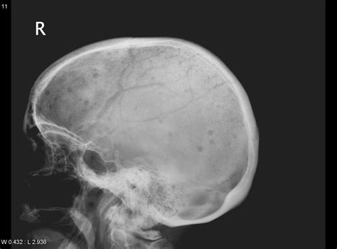 Multiple Myeloma