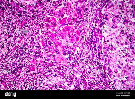 Histopathology Of Portal Liver Cirrhosis Light Micrograph Photo Under