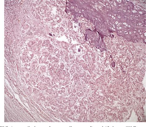 Figure 1 From Large Cell Calcifying Sertoli Cell Tumour With