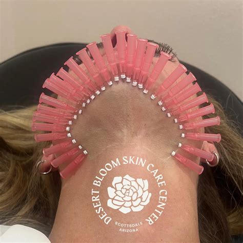 Benefits Of Pdo Thread Lift Neck A Non Surgical Solution For Neck Lifting