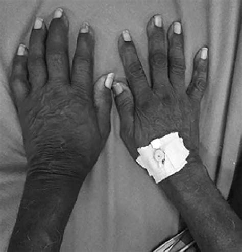 Swelling Of Metacarpophalangeal Joints And Proximal Interphalangeal Download Scientific Diagram