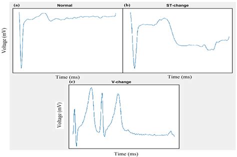 Electronics Free Full Text Multiclass Ecg Signal Analysis Using