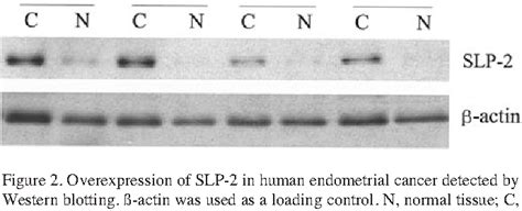 Figure 1 From Stomatin Like Protein 2 Is Overexpressed And Related To