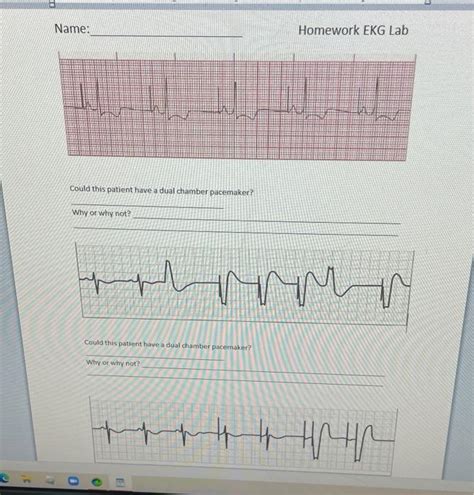 Solved Ame Homework Ekg Lab Could This Patient Have A Dual