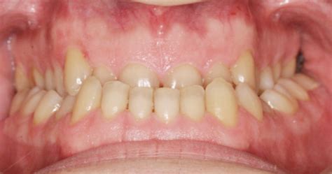 ¿qué Causa La Maloclusión Dental Tipos De Maloclusiones
