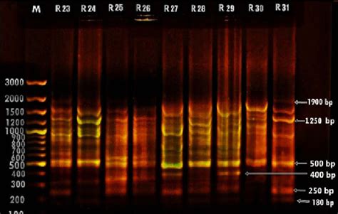 Gel Electrophoresis Of Rapd Pcr Product Of Papillary Renal Carcinoma
