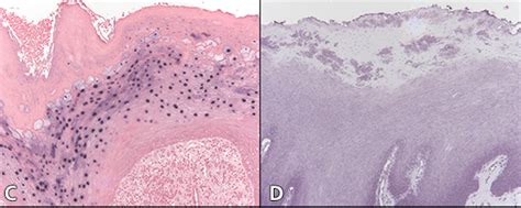 Hairy Leukoplakia Histology