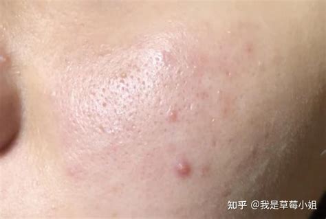 如何有效淡化脸上的痘印？ 知乎