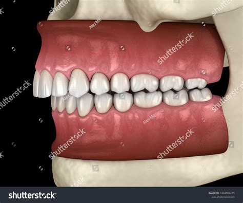 Ilustrasi Stok Overbite Dental Occlusion Malocclusion Teeth Medically