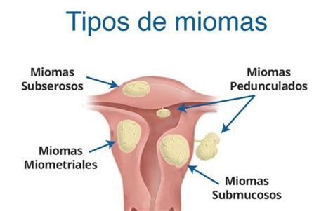 Miomas Uterinos Noticias Farmacias Homeopáticas Hernández