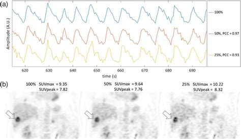 Ideal Continuous Bed Motiondata Driven Respiratory Gating Cbmddg