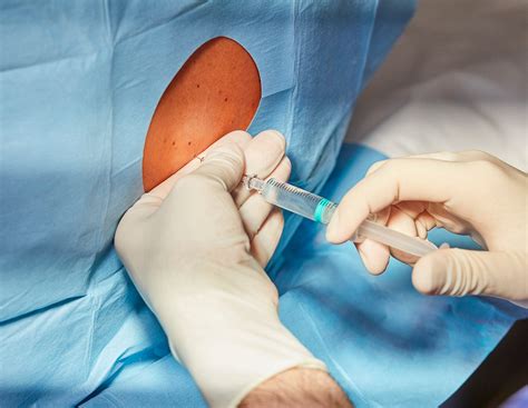 Epidural Injection In New Jersey Gerling Spine Care And Research Institute