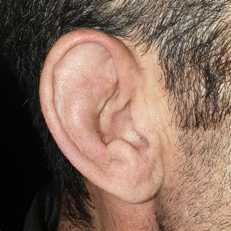 Auricular Cellulitis