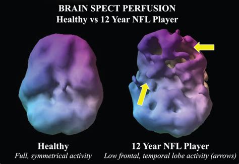 Traumatic Brain Injuries From Playing In The Nfl Can Be Diagnosed With