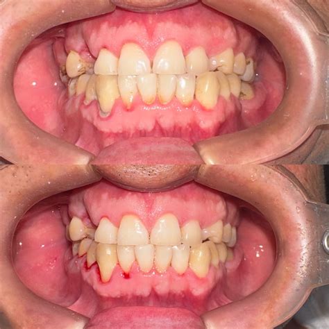 Tienes Los Dientes Con Manchitas Visítanos Para Darle Solución Con Una