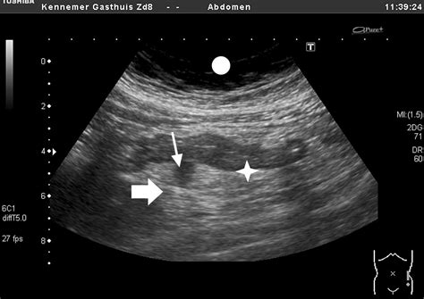 Suspected Left Sided Diverticulitis The Bmj