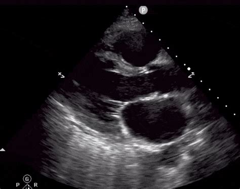 Assessing Left Ventricular Ejection Fraction With 51 Off