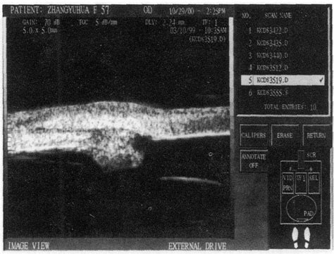 小梁切除术后2年，滤过泡扁平 眼科超声生物显微镜检查 医学