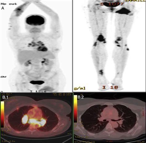 Cutaneous Sarcoidosis Preamble Of A Paucisymptomatic Systemic Disease Reumatología Clínica