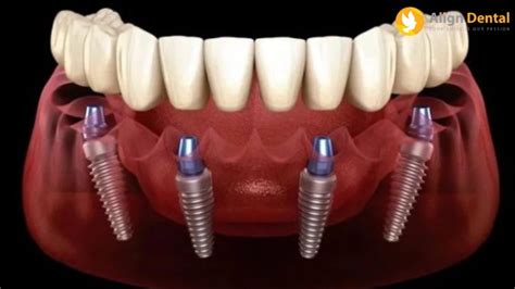 Công Nghệ Cấy Ghép Trồng Răng Implant Không Đau Hiện Đại Nhất