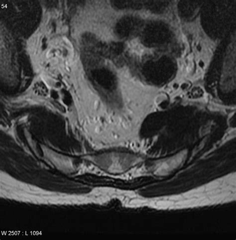 Piriformis Syndrome Radiology Reference Article