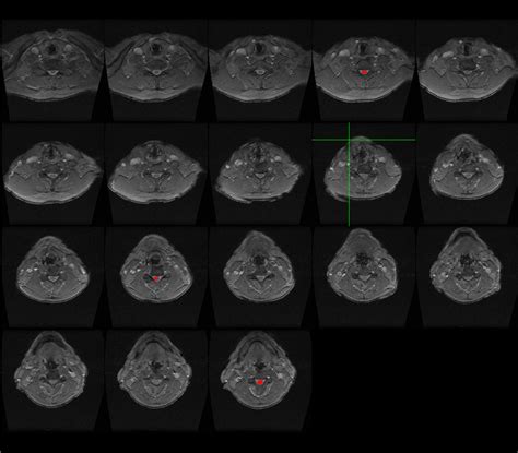 `sct deepseg sc` performs poorly on images with spinal cord compression