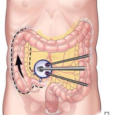 Dissection Is Proceeded To The Rectosigmoid Junction Download