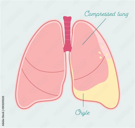 Chylothorax Anatomical Scheme In Hand Drawn Style Gathering Of Chyle