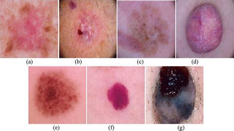 Sample Skin Cancer Images From The Ham10000 Dataset The Images Show A
