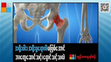 အရိုးပါး၊ အရိုးပွရောဂါ မဖြစ်အောင် ဘာတွေဆောင်သင့်ရှောင်သင့်သလဲ Youtube