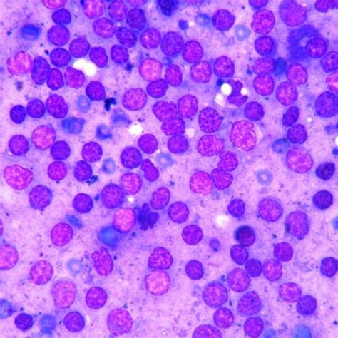 Lymph Node Aspirates Showing Mixed Population Of Lymphocytes And