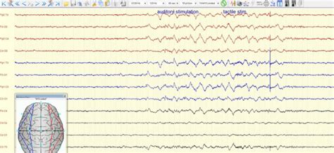 Eeg Reactivity In Coma Atlas Of Science
