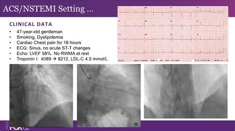 Optimal Pci In Patient With Long Calcified Lesion