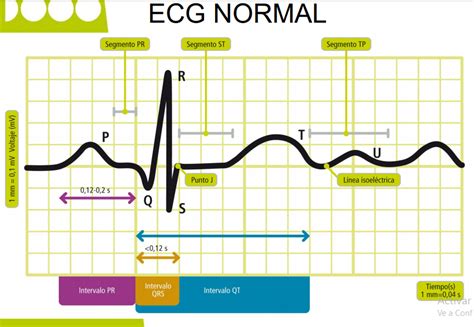 Analisis De Ecg Mediante Transformada Wavelet Mapa Mental