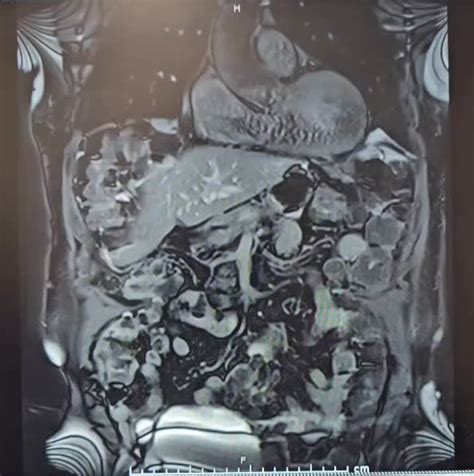 Video Faisal Nawaz On Linkedin Endoscopic Retrograde Cholangio