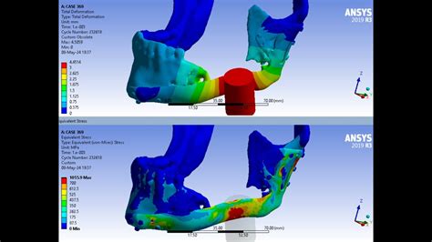 High Load Impact Simulation On The Implant Of A Mandibular Fracture Ansys Wb Explicit Dynamics
