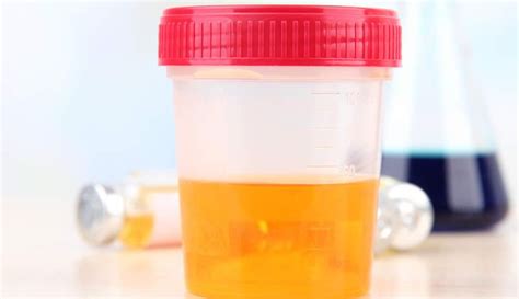 Does Liver Disease Cause Dark Urine