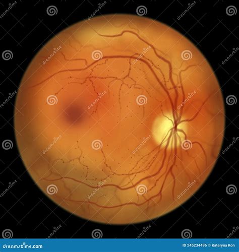 Diabetic Retinopathy Ophthalmoscopic Diagnosis Illustration Royalty