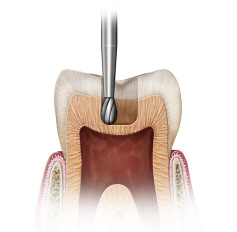 Fg Carbide 2 Pear Ss White Dental