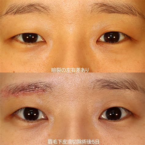 眉毛下皮膚切除 Tetsu形成・美容クリニック 田中哲一郎のブログ