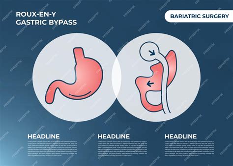 Premium Vector Roux En Y Gastric Bypass Rny Weight Loss Surgery