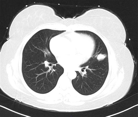 Computed Tomography Scan Showed An Irregular Abnormal Soft Tissue Mass Download Scientific