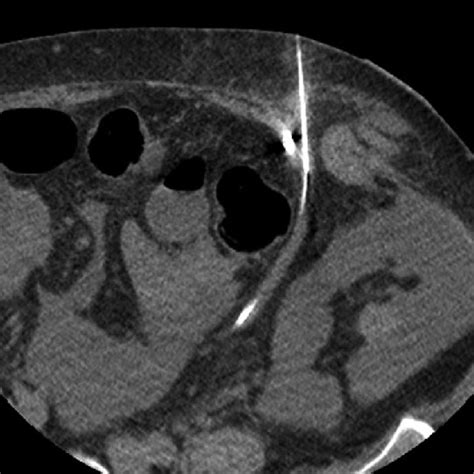 After Coil Embolization Arrows Gelfoam Slurry Was Then Injected