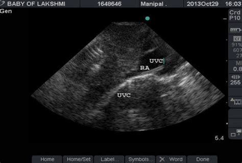 Uvc Tip In Right Atrium Download Scientific Diagram